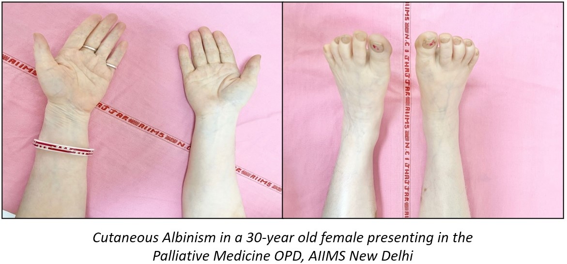 Albinism and Palliative Care - I A P C